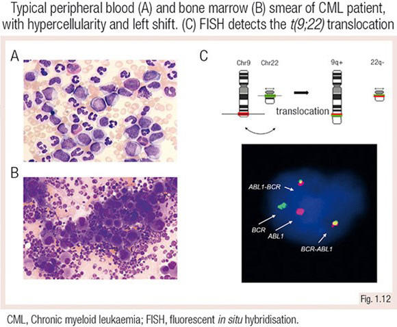 AML和CML分类|必威投注限额OncologyPRO - 必威im电竞,biwei必威体育备用网站,必威投注网址